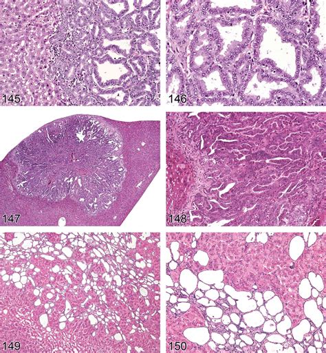 Mouse Liver Cholangioma Figure 146 Mouse Liver Cholangioma Higher