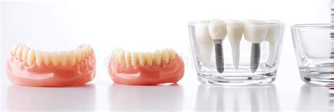 comparison of bridge denture and implant types for dental restoration