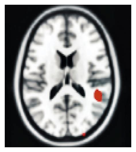 Analysis Results Of Resting State Functional Connection Between The Two Download Scientific