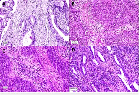 Tumor Infiltrating Lymphocytes Tils A Adenocarcinoma With 5 Of Download Scientific