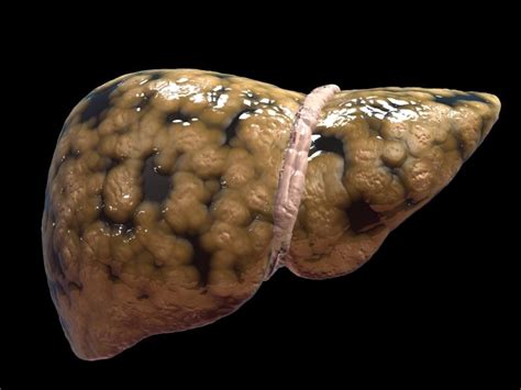 Liver Stiffness But Not Fatty Liver Disease Linked To Atrial Fibrillation Multidisciplinary