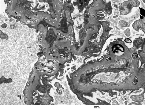Lecithincholesterol Acyltransferase Deficiency With Subepithelial