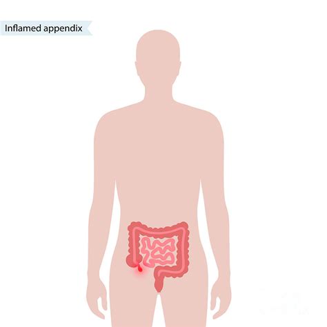 Inflamed Appendix Photograph By Pikovit Science Photo Library Fine