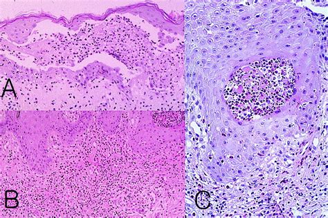 Pyodermatitis Pyostomatitis Vegetans With Circulating Autoantibodies To