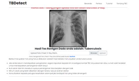 GitHub Brnsbrn TBDetect Application That Can Define Someone With Tuberculosis Using Chest X Ray