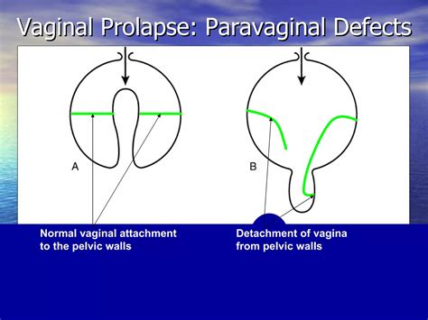 Evaluation Management Of Genital Prolapse