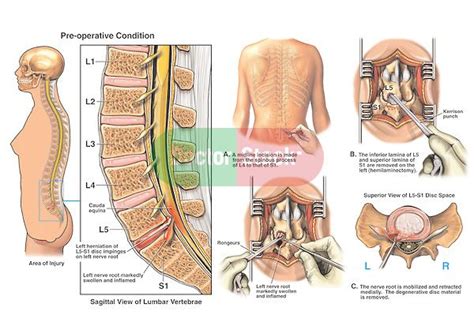 Back Surgery L5 S1 Disc Herniation With Hemilaminectomy And Discectomy Diskectomy Shows A