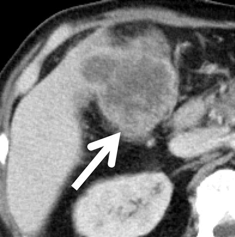 Ct There Is An Irregular Gallbladder Mass About 90 Mm In Diameter With Download Scientific