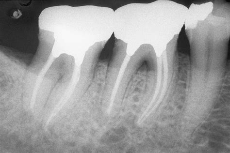 Restoration Of Endodontically Treated Teeth Pocket Dentistry