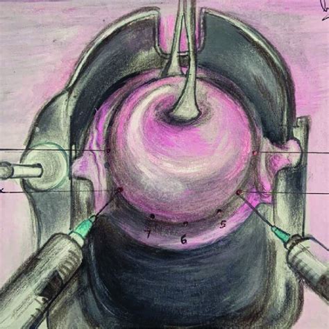 Illustration Of Paracervical Block Download Scientific Diagram