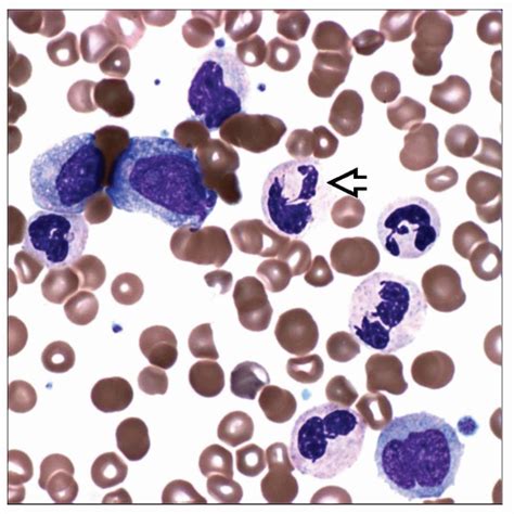 Overview Of Myelodysplastic Myeloproliferative Neoplasms Basicmedical Key