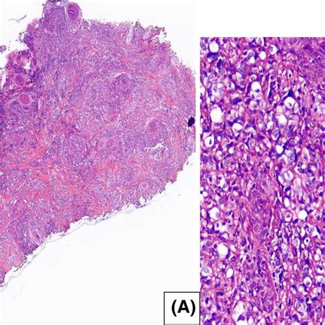 Post‐auricular Lesion A Ulcerated Epithelium With Diffuse Download Scientific Diagram
