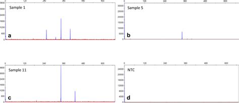 A D Genescan Based Fragment Length Analysis Of Flt3 Itd Mutation Was