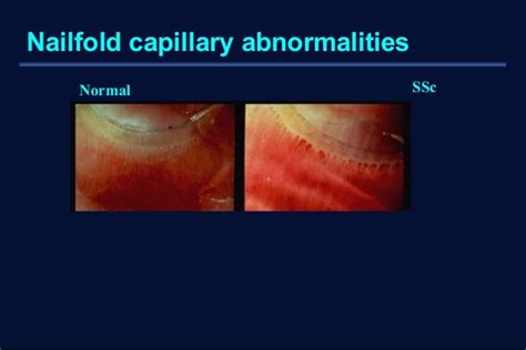 Scleroderma