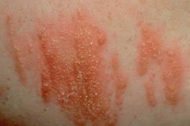Poison Ivy Oak And Sumac Foothill Dermatology Medical Center
