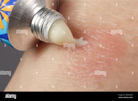 Close Up Image Of Ointment Applying On The Eczema Atopic Dermatitis