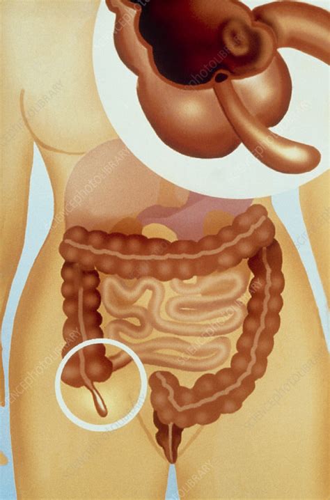Appendix Location In Women