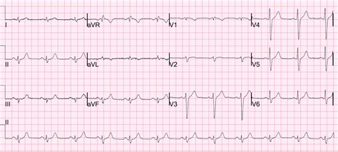 Hyperacute T Waves Archives Dr Smiths Ecg Blog
