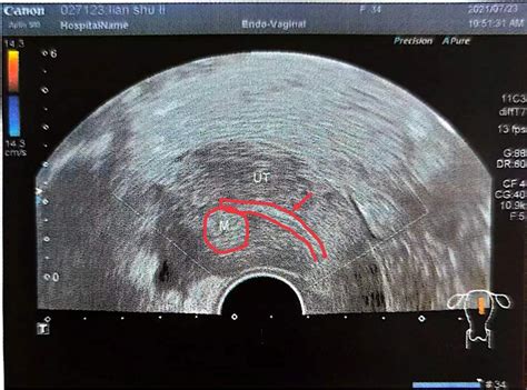 sonographic presentation of type 3 myoma and the endometrium download