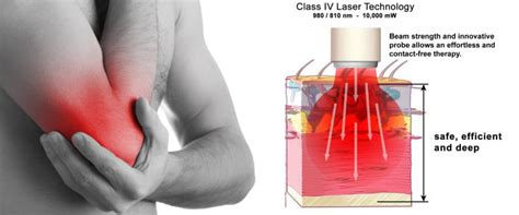 Class Iv Laser Therapy In West La And Santa Monica Dr Jack Li