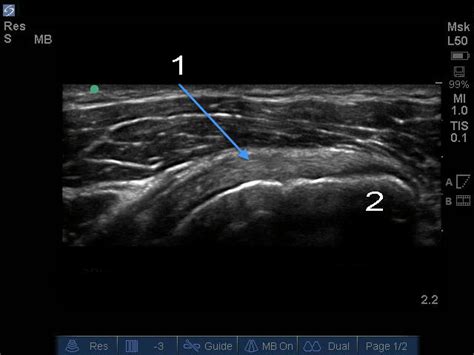 Shoulder Subscapularis Tendon Longitudinal Axis Image Sonosite Institute For Point Of Care