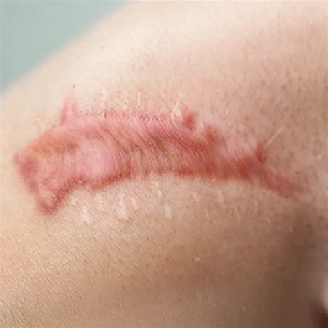 Hypertrophic Acne Scar 3 Hundred Hypertrophic Scars Acne Royalty Free