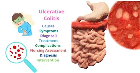 Ulcerative Colitis Causes Symptoms Diagnosis Treatment Complications