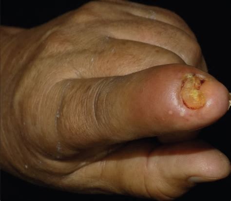 Periungual Deep Seated Granulomatous Pyoderma Gangrenosum Indian