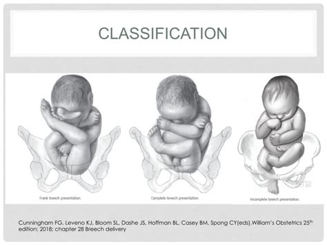 Steps In Partial And Complete Breech Delviery Ppt