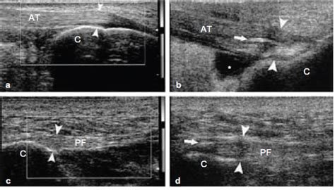 A And C Achilles Tendon Shows Normal Ultrasound Appearance With Download Scientific Diagram