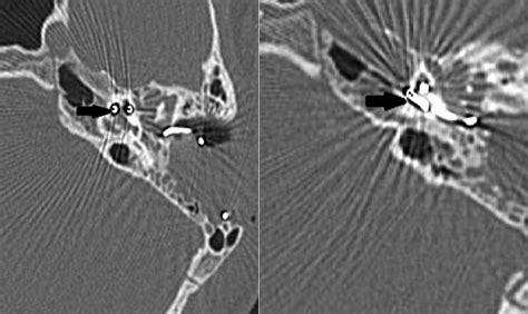 Postoperative Temporal Bone High Resolution Computed Tomography Of The