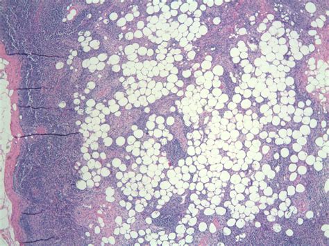 Pathology Outlines Adipose Tissue