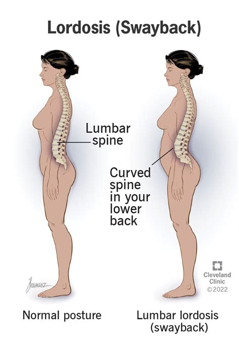 Lordosis Definition Causes Symptoms Diagnosis And 51 Off