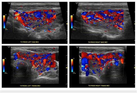 Abnormal Thyroid Ultrasound Images
