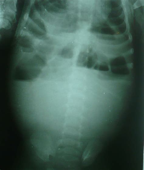 Abdominal Radiograph Suggestive Of Mass Effect And Intestinal