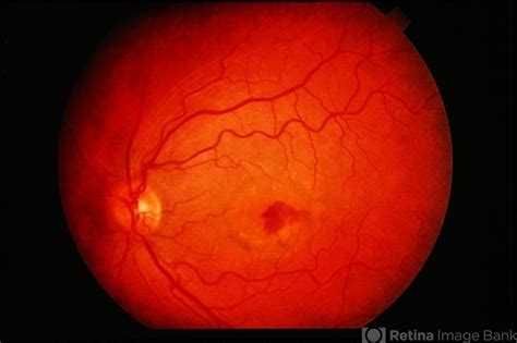 Reticular Pattern Dystrophy Retina Image Bank