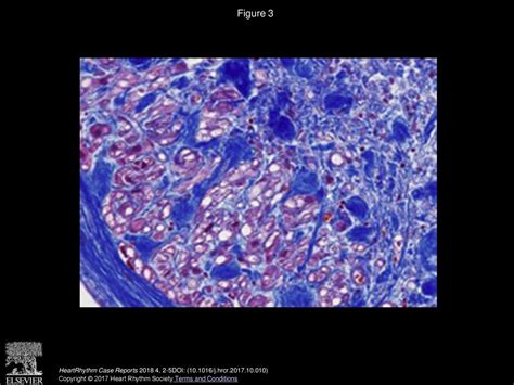 Ectopic Atrial Tachycardia Originating From Right Atrial Appendage