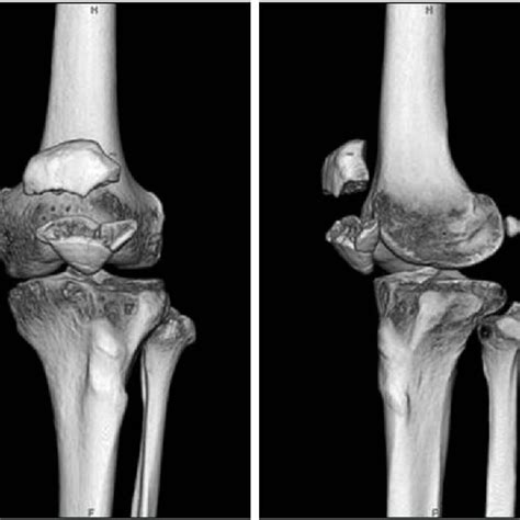 A Ultrasound Image Showing The Left Sciatic Nerve At The Mid Thigh Download Scientific