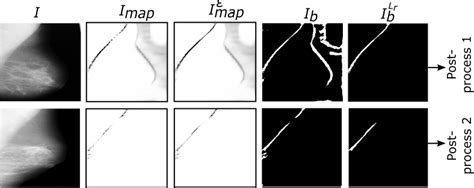 Figure 1 From Breast Pectoral Muscle Segmentation In Mammograms Using A Modified Holistically