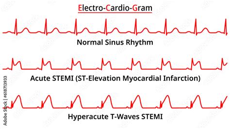Naklejka Set Of Ecg Common Abnormalities Acute Hyperacute Stemi St