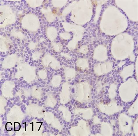 Pathobiolab A Challenging Case Of Canalicular Adenoma Of