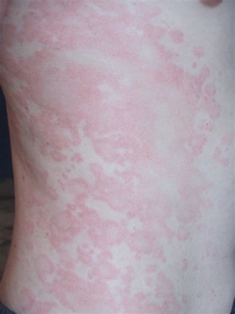 Красные пятна на коже фото и названия