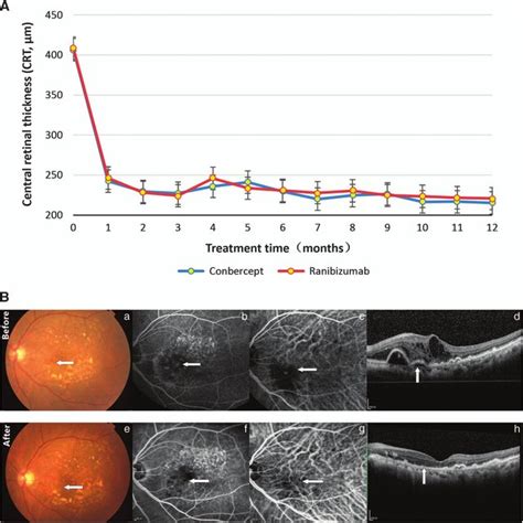 Secondary Outcomes In Conbercept And Ranibizumab Groups Over 1 Year Download Scientific