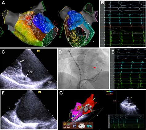 Anatomic Approach To Mitral Isthmus Ablation Guided By Left Atrial Intracardiac Echocardiography