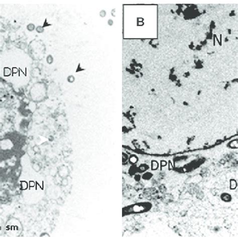 Electron Micrographs Of Dilated Perinuclear Space And Endoplasmic