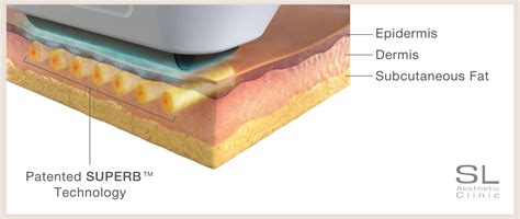 Sofwave™ Singapore Intense Skin Tightening And Wrinkle Reduction