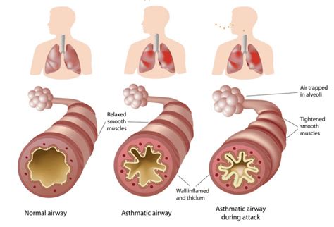 Blog Trudoc Medical Llc Pulmonary And Critical Care Medicine Clifton