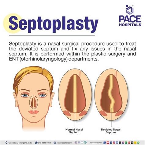 Septoplasty