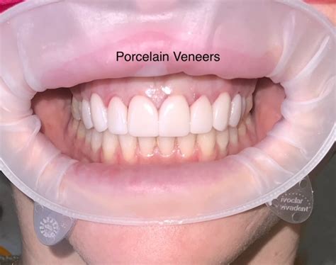 Porcelain Veneers Process