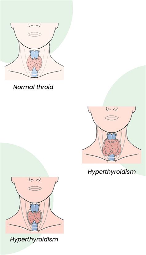 Thyroid And Itchy Skin Find The Link Symptoms And Treatment Options Clinicspots